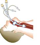 combitube – Streetwatch: Notes of a Paramedic